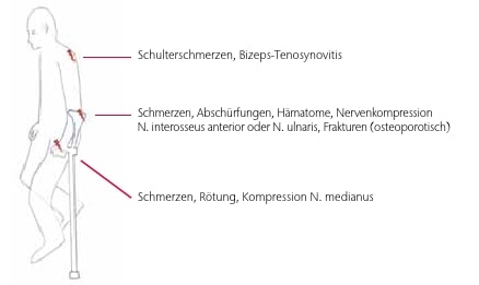 Sind Folgeschäden an Handgelenken und Schultern durch jahrelanges Gehen ...
